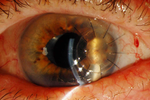 A rare case of Mycobacterium chelonae keratitis - nzoptics