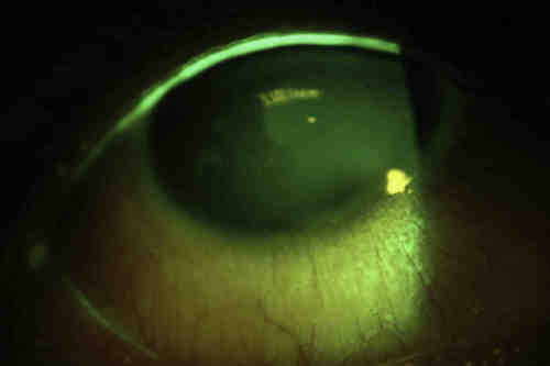 Bandage Contact Lenses - nzoptics