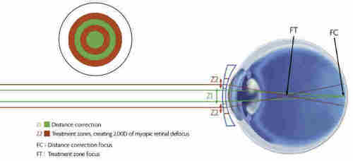 Non-ortho-k CL options for myopia control - nzoptics