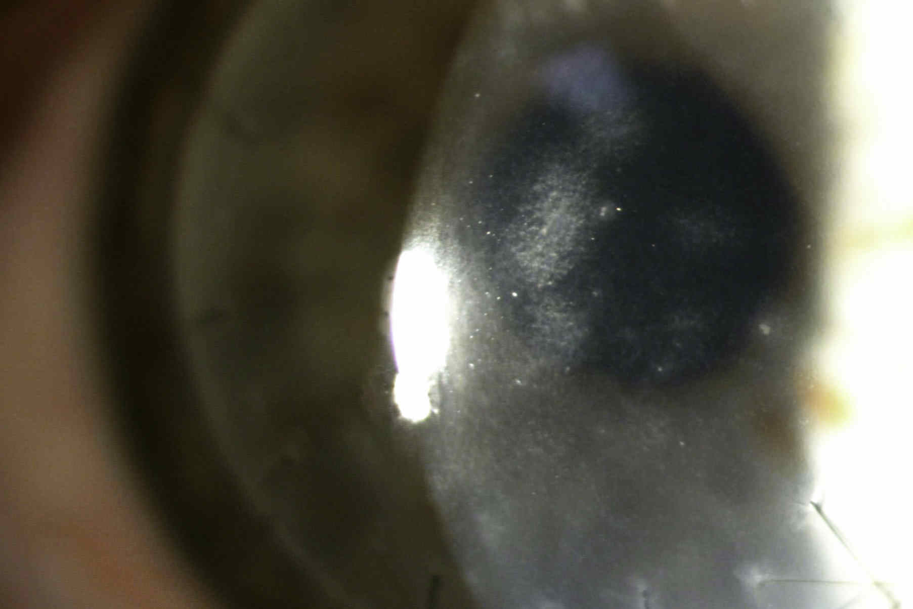 Corneal transplant rejection: principles and clinical management ...