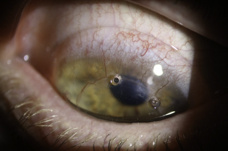 RGPs and corneal graft patients - eyeonoptics