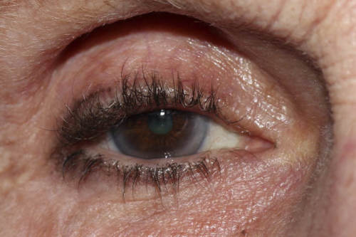 Troublesome lashes - eyeonoptics