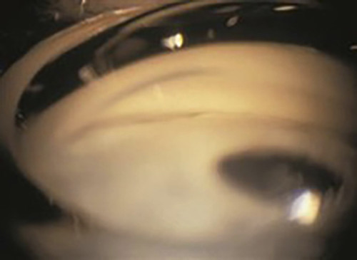 Gonioscopy – a closer look at the angle - nzoptics