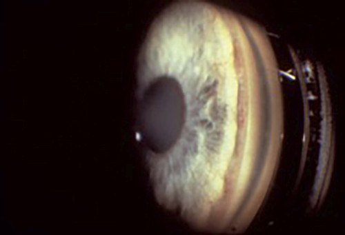 Gonioscopy – a closer look at the angle - eyeonoptics