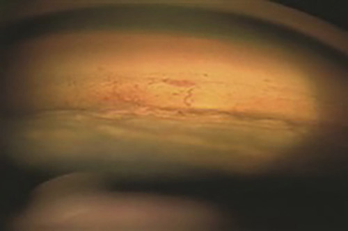 Gonioscopy – a closer look at the angle - nzoptics