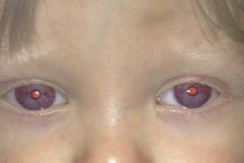 Albinism 101 - nzoptics