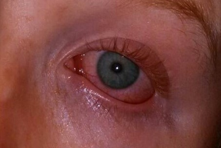 Conjunctivitis, a sign for Covid-19? - eyeonoptics