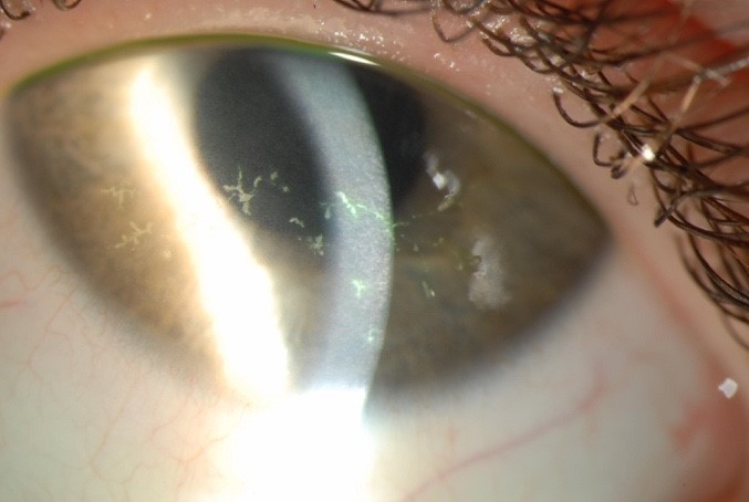 Herpes zoster ophthalmicus - eyeonoptics