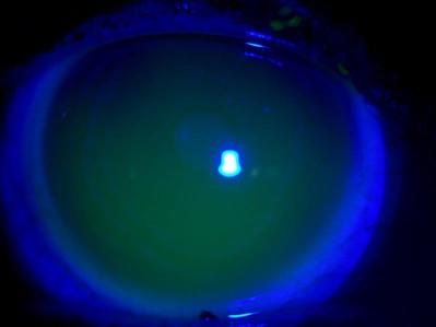 Scleral lenses in DED management - nzoptics