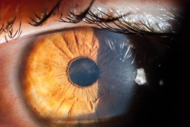 Acanthamoeba Corneal Ulcer