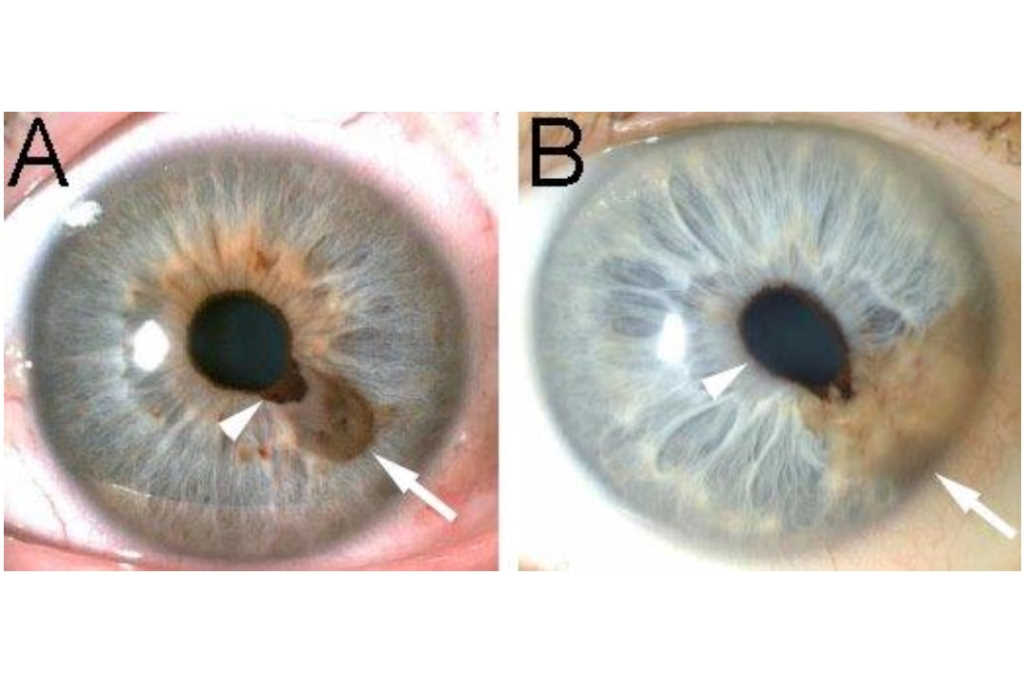 The iris in health and disease: part 1 - normal variations and mass ...
