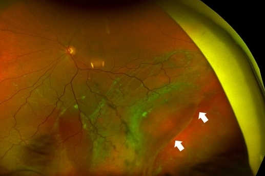 Atopic dermatitis and retinal detachment - nzoptics