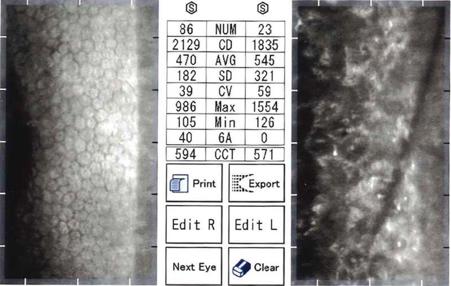 Fuchs’ endothelial corneal dystrophy: beaten metal to rock - nzoptics