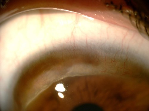 Unravelling the mystery of corneal peripheral thinning disorders - nzoptics