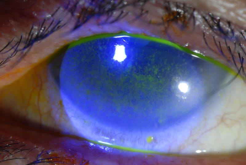 DED and immune-mediated diseases