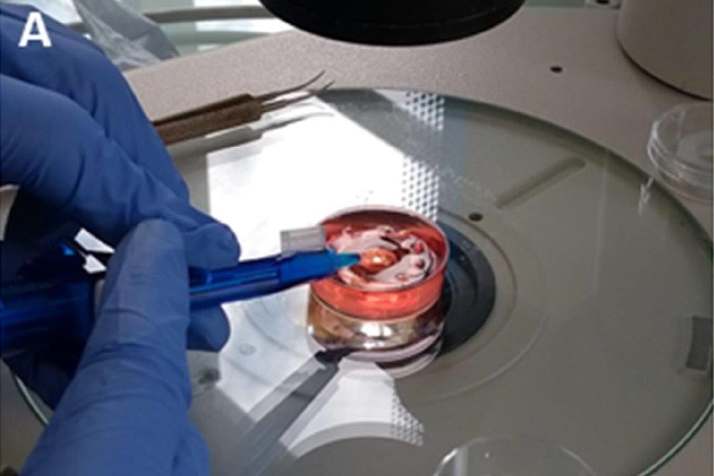 3D printing to revolutionise cataracts treatment?