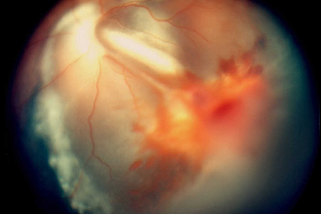Posterior-eye treatment potential