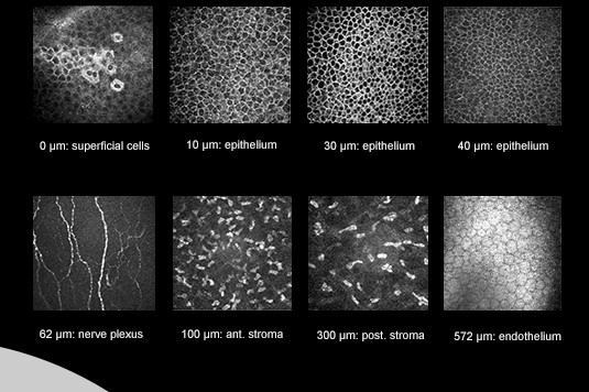 The return of the HRT3 corneal microscope