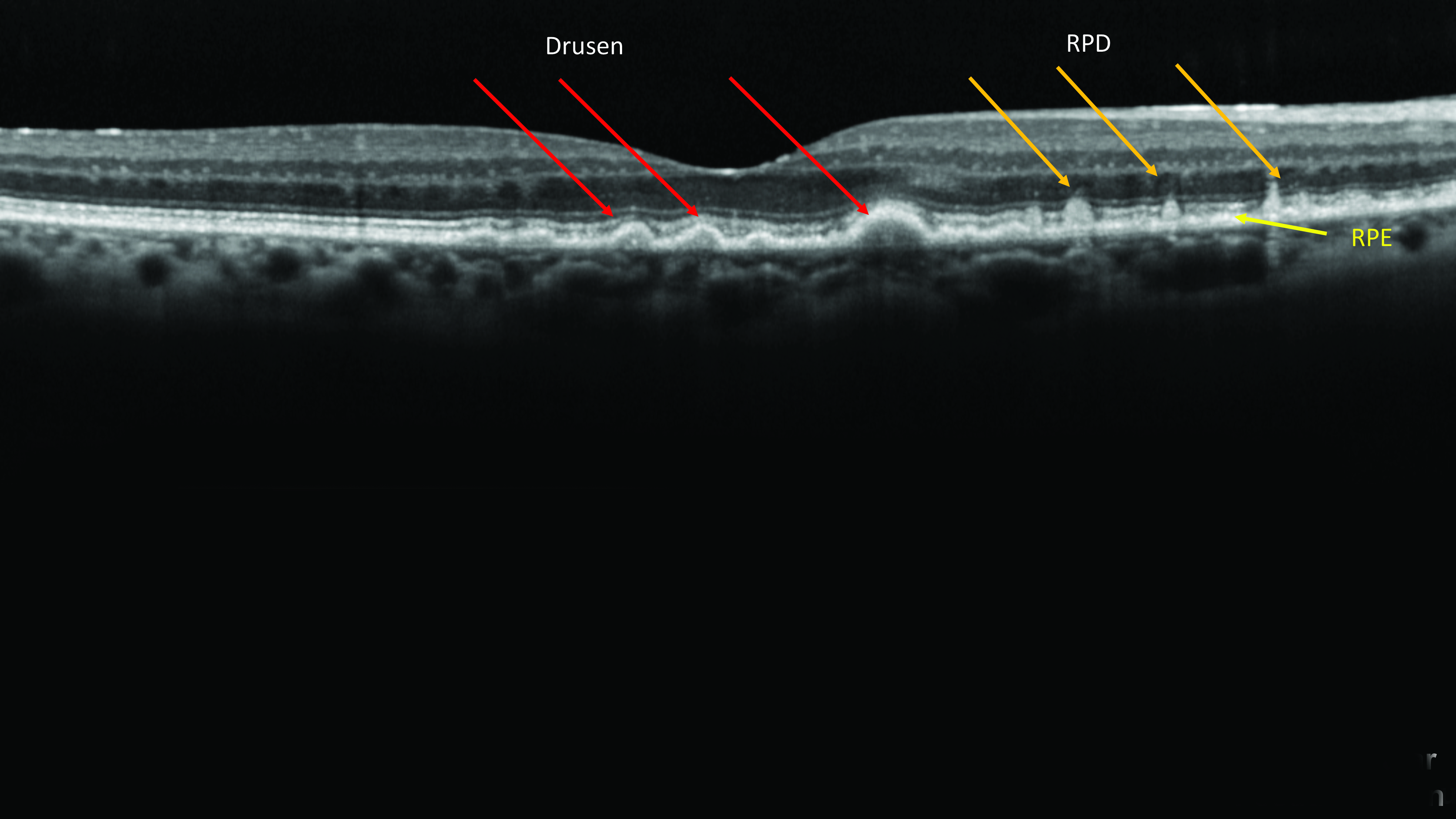 Getting to grips with RPD and AMD